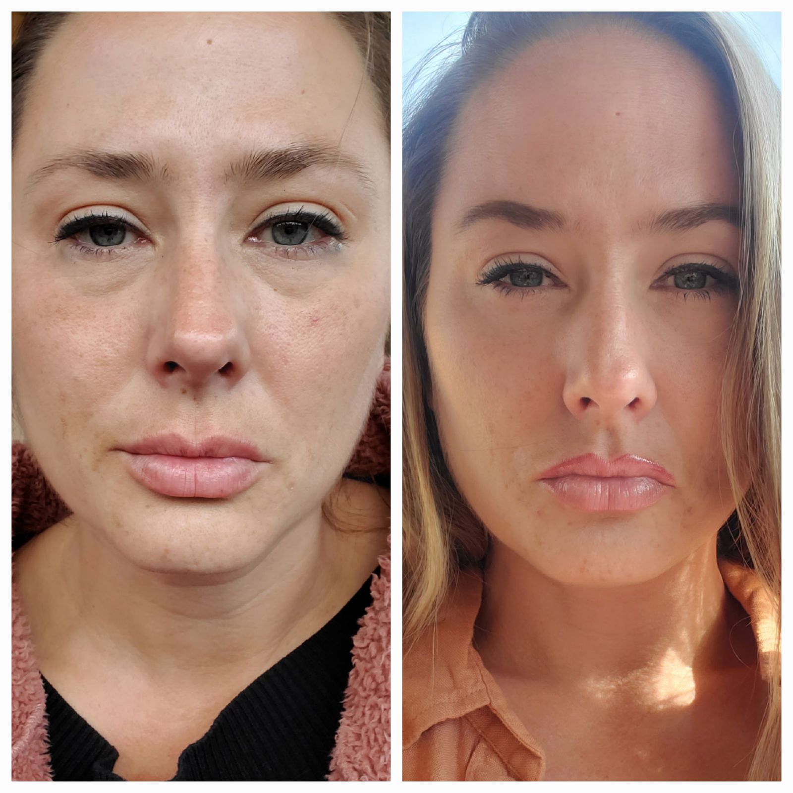 The All-In-One Facial - Set | Hanacure®