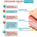 Pressure Injury Stages | Infographic – Dietitians On Demand