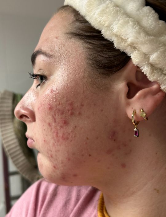 acne hack OG bundle – tbhskincare